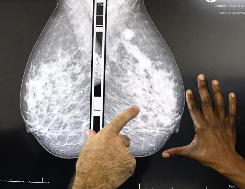 Top breast cancer surgeon quits Helen Joseph Hospital, volunteers follow